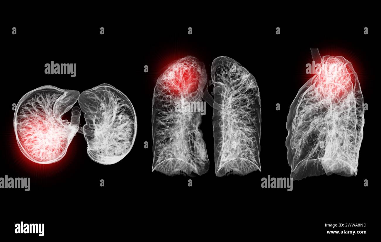 A CT chest 3D scan displaying a lesion at the right upper lobe offers a ...