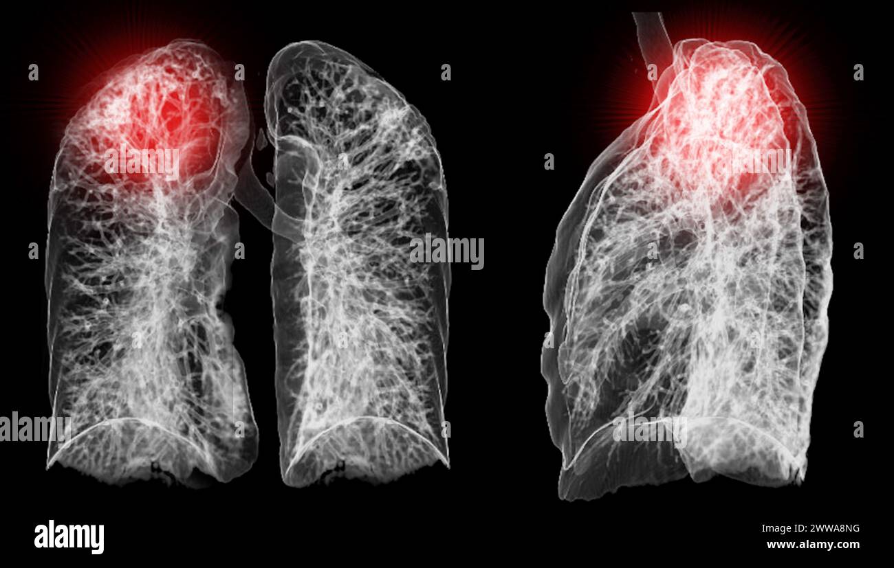 A CT chest 3D scan displaying a lesion at the right upper lobe offers a ...