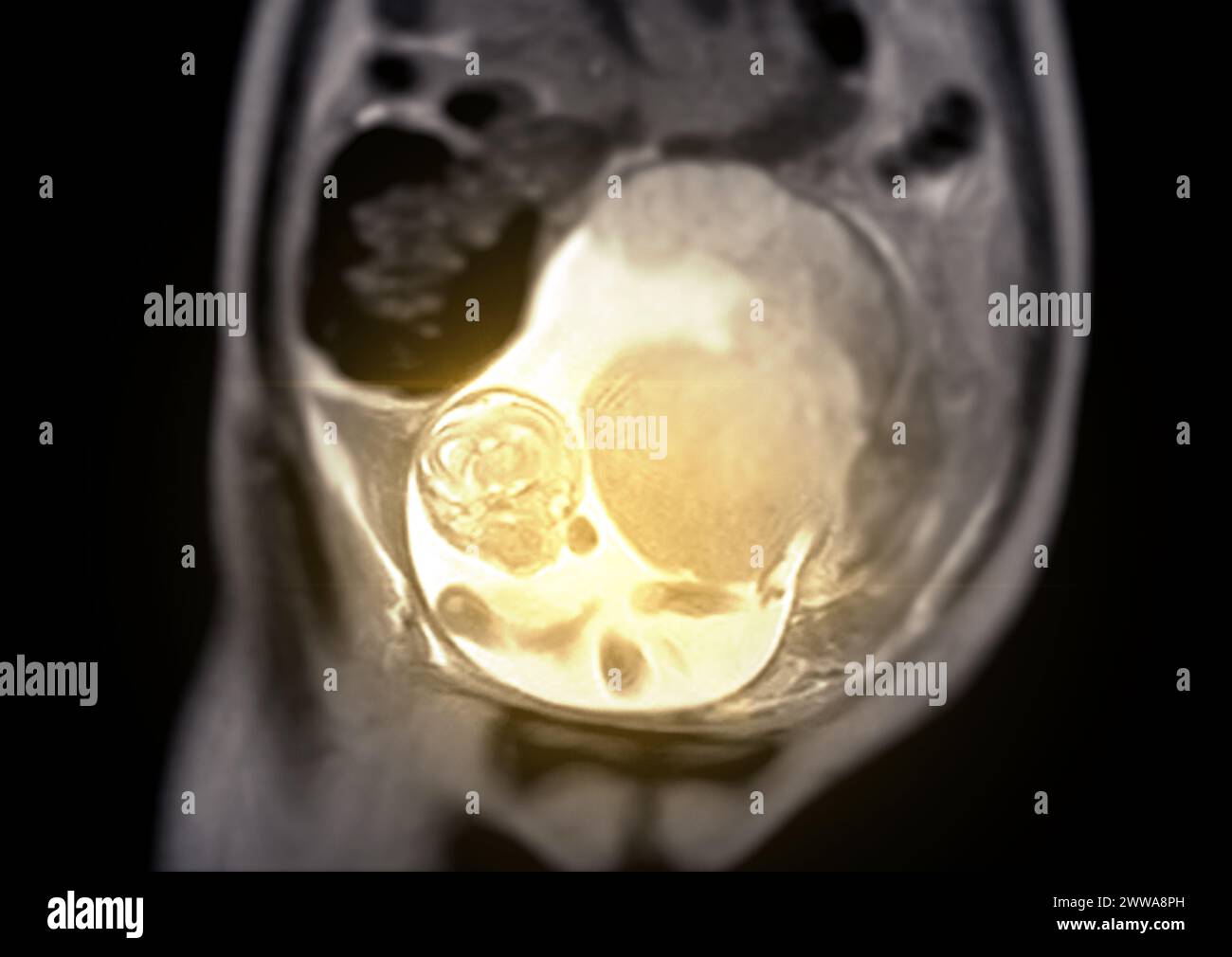 Fetal mri hi-res stock photography and images - Alamy