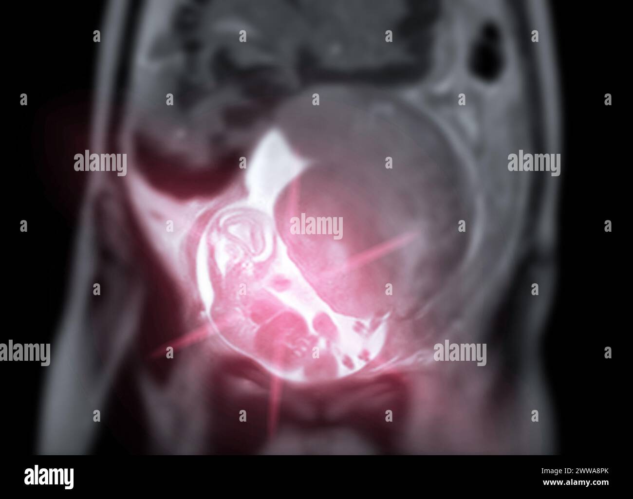 MRI during pregnancy ensures non-invasive evaluation of fetal health ...