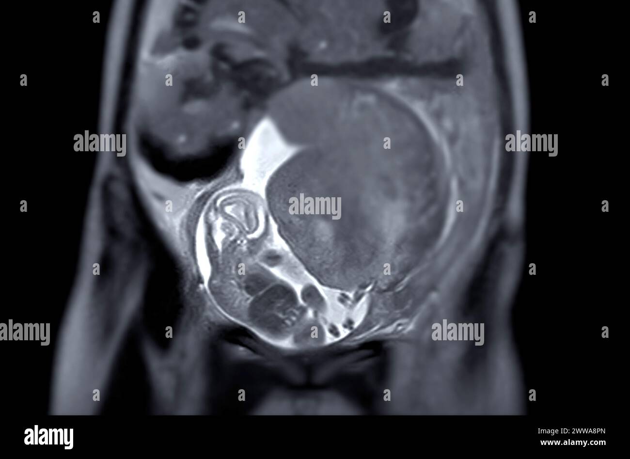 Fetal mri hi-res stock photography and images - Alamy