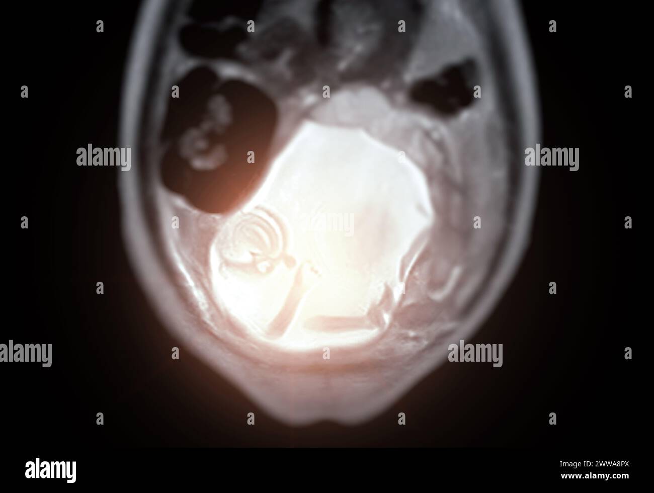 MRI during pregnancy ensures non-invasive evaluation of fetal health ...