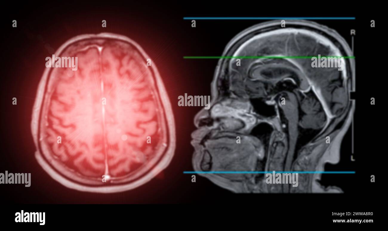 MRI brain scan sagittal plane for detect Brain diseases sush as stroke ...