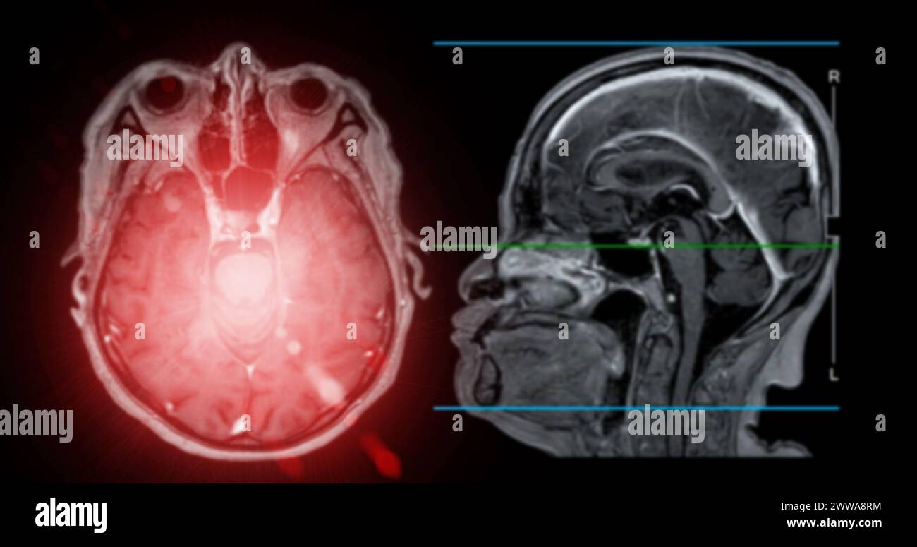 MRI brain scan sagittal plane for detect Brain diseases sush as stroke ...