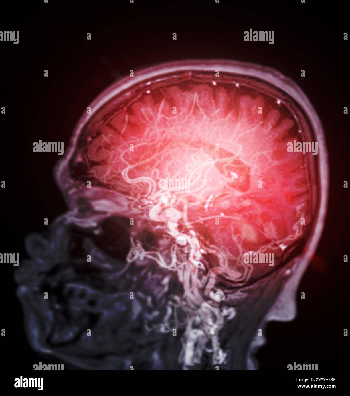 MRI brain scan sagittal plane for detect Brain diseases sush as stroke ...