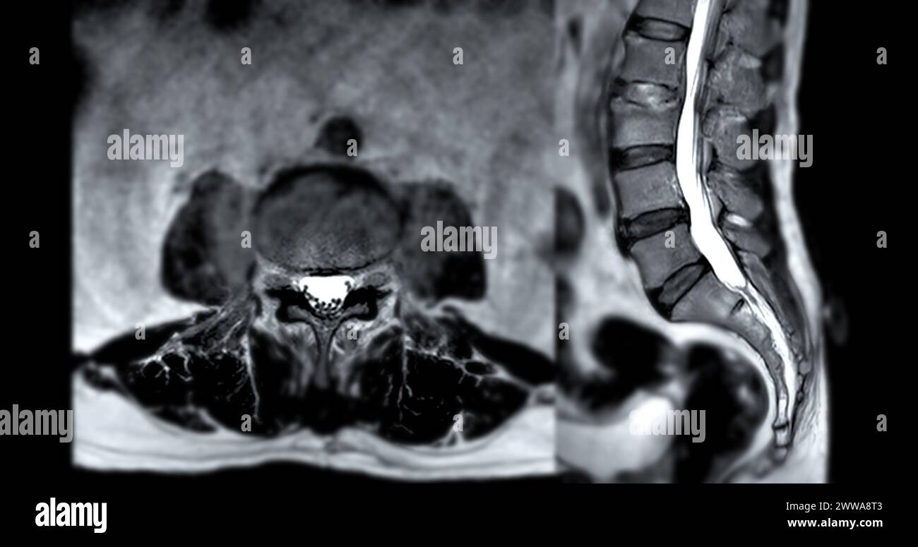 MRI L-S spine or lumbar spine Axial and sagittal T2 technique with ...