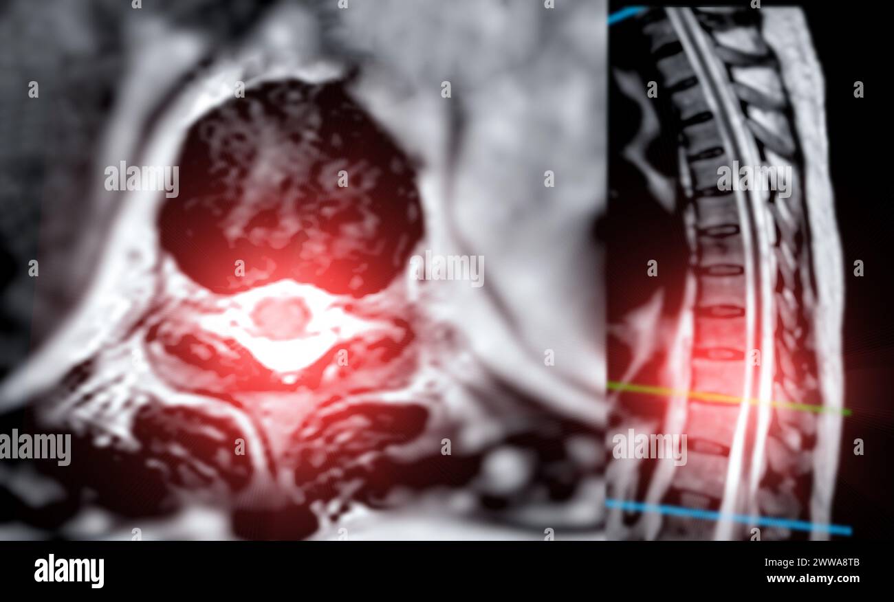 MRI T-L spine or Thoracosacral spine Axial and sagittal T2 technique with reference line for ...