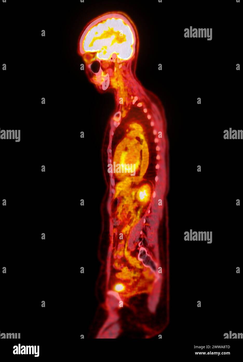 Brain pet scan screen hi-res stock photography and images - Alamy