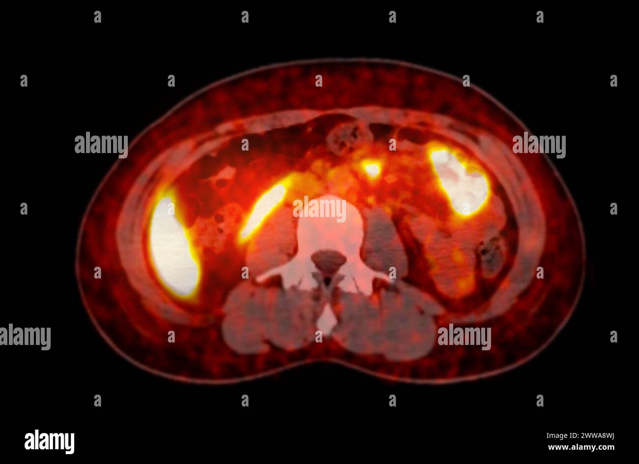 A PET-CT scan image is a diagnostic visualization combining Positron ...