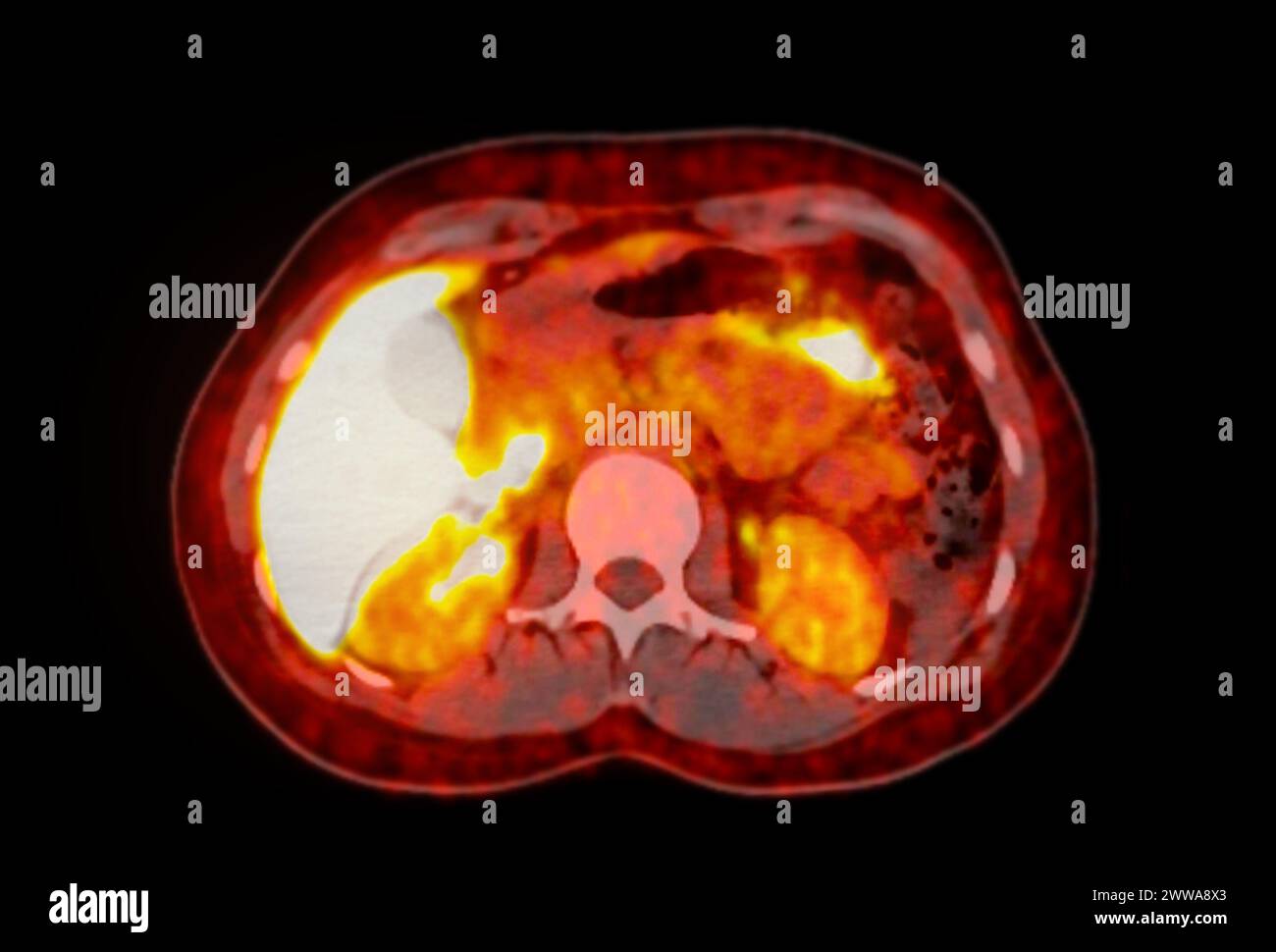 A PET-CT scan image is a diagnostic visualization combining Positron ...