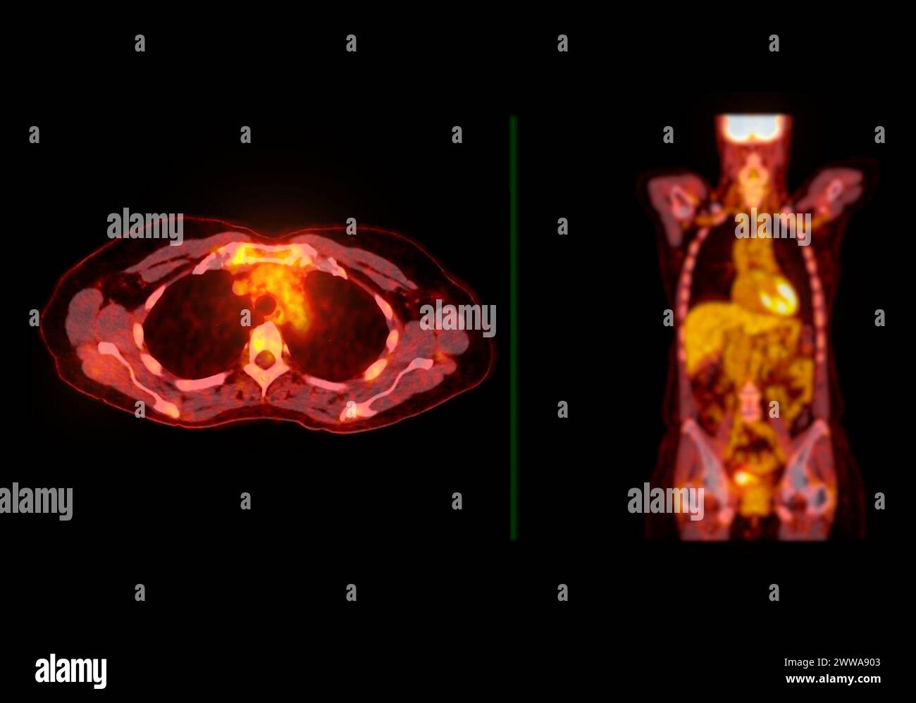 A PET-CT scan image is a diagnostic visualization combining Positron ...