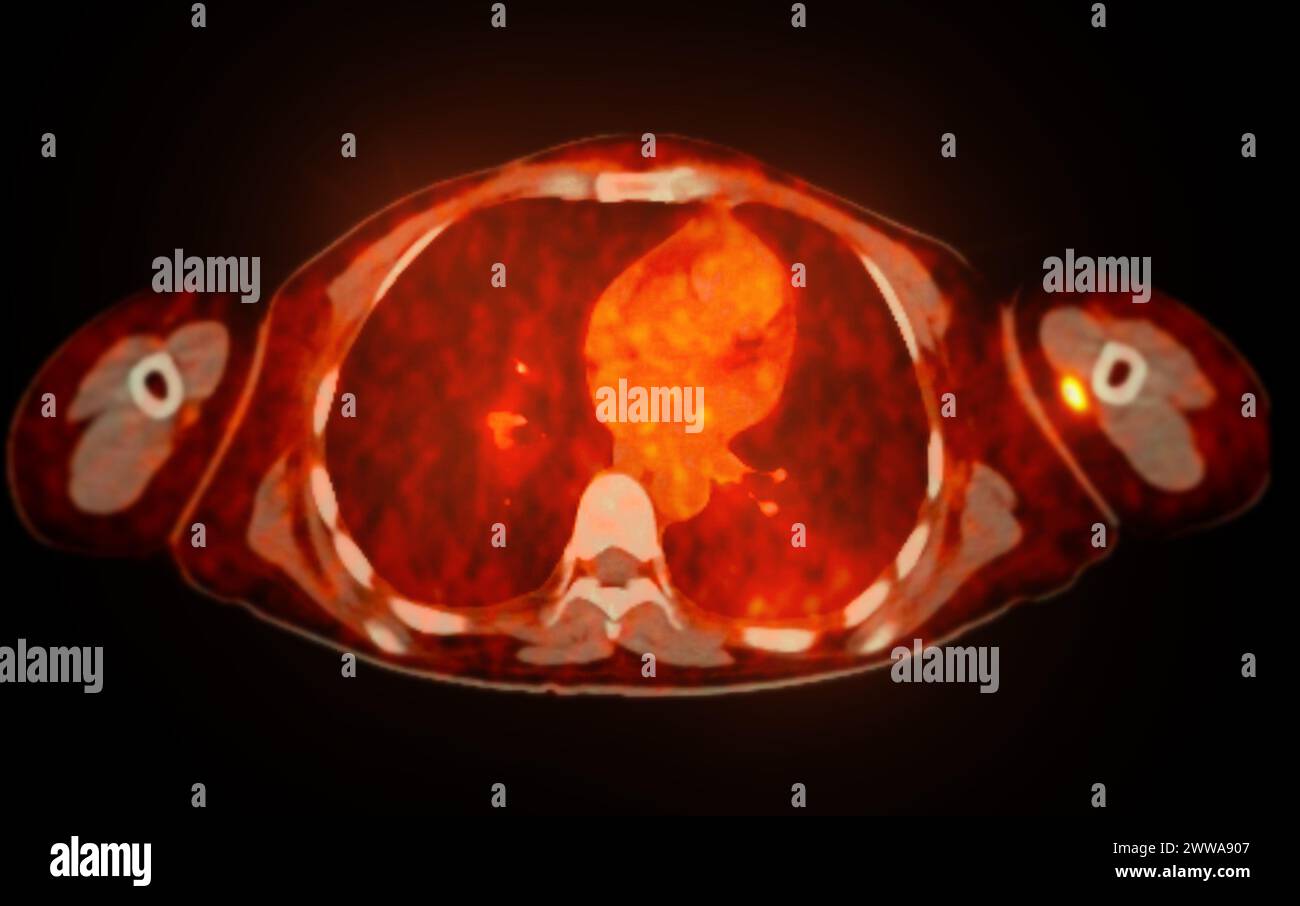 A PET-CT scan image is a diagnostic visualization combining Positron ...