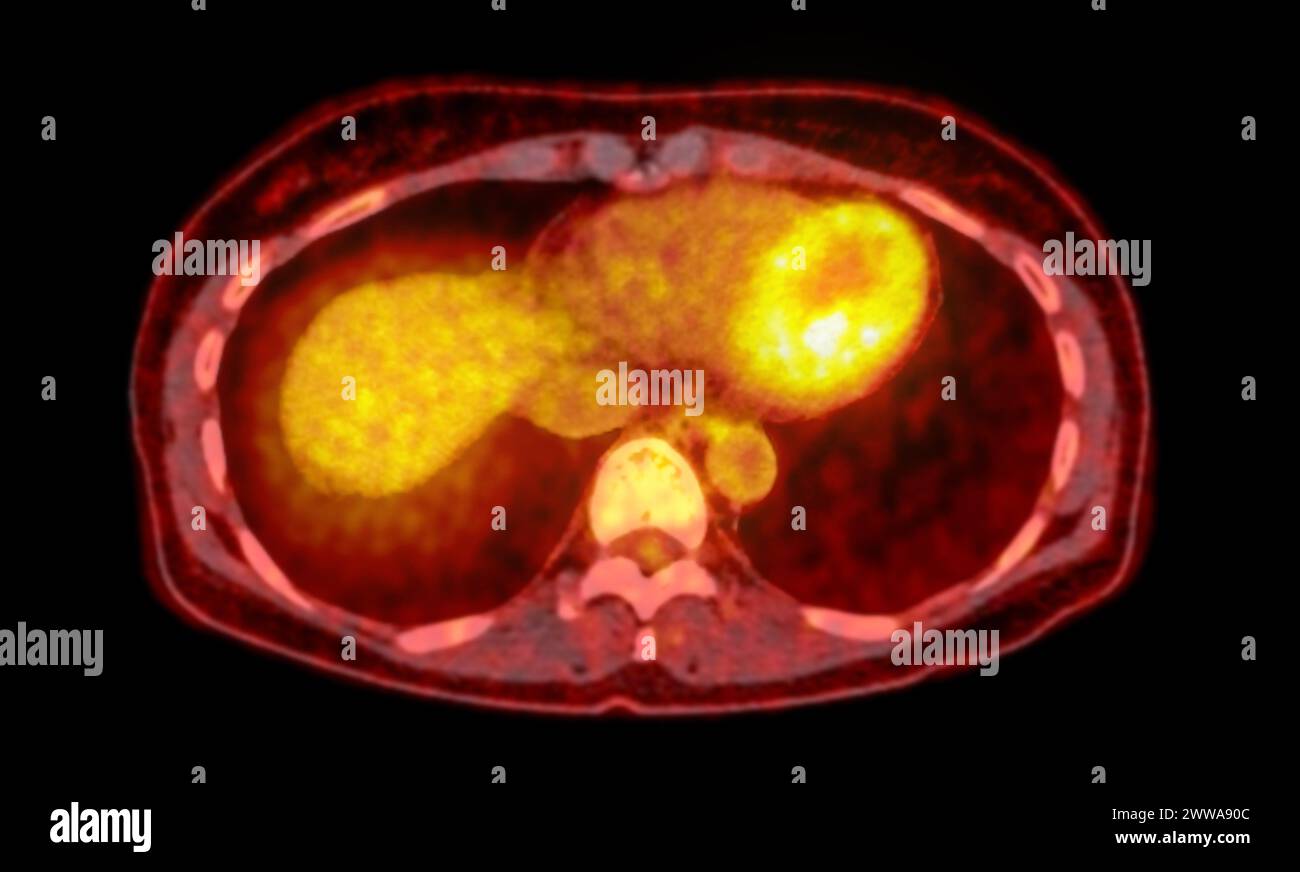 A PET-CT scan image is a diagnostic visualization combining Positron ...