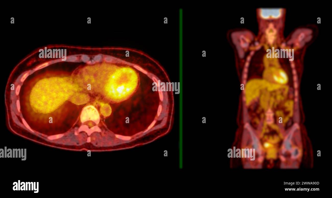 A PET-CT scan image is a diagnostic visualization combining Positron Emission Tomography (PET ...