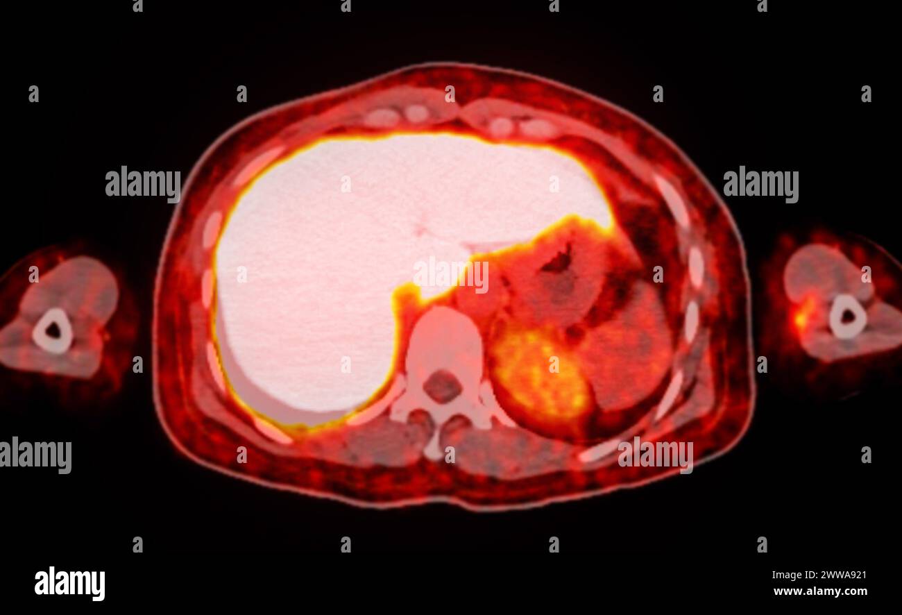 A PET-CT scan image is a diagnostic visualization combining Positron ...