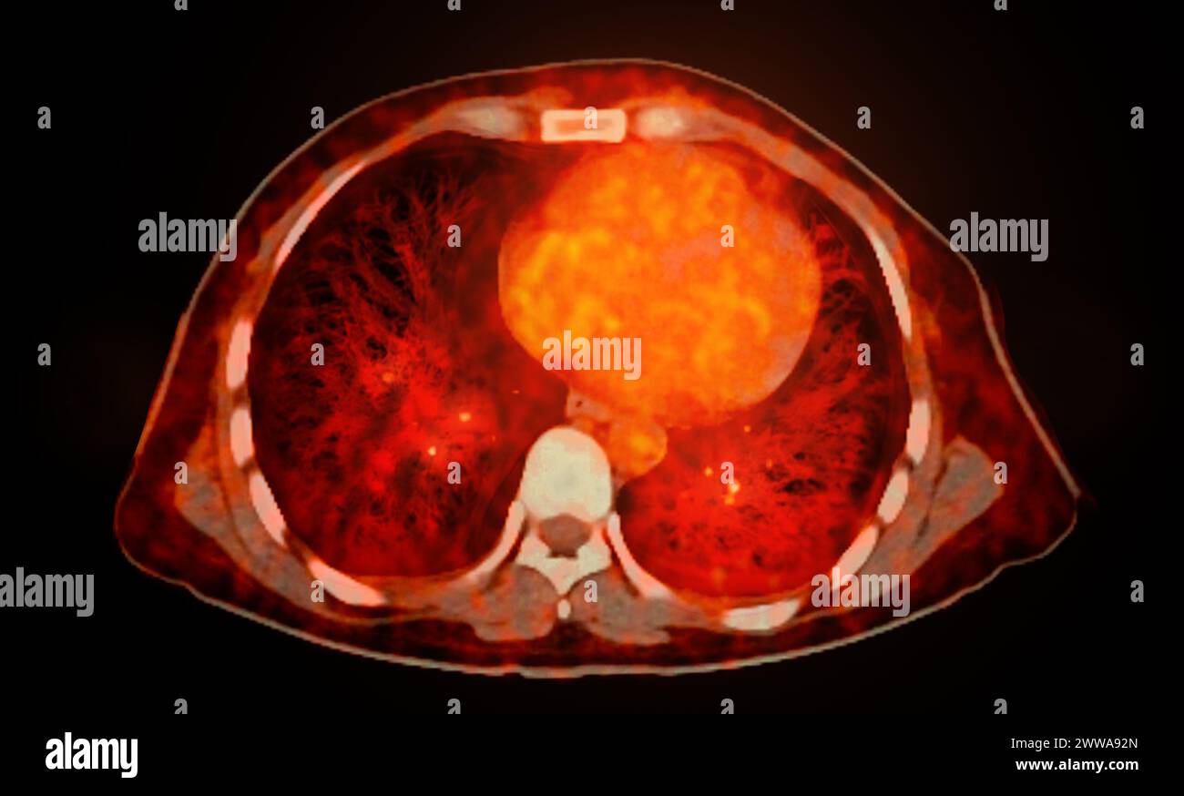 A PET-CT scan image is a diagnostic visualization combining Positron ...