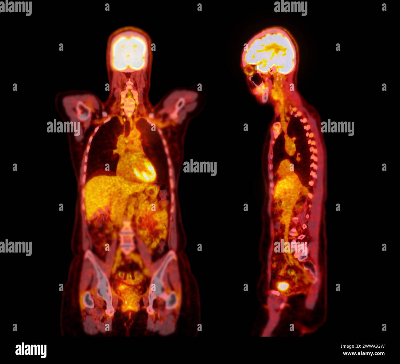 A PET-CT scan image is a diagnostic visualization combining Positron ...