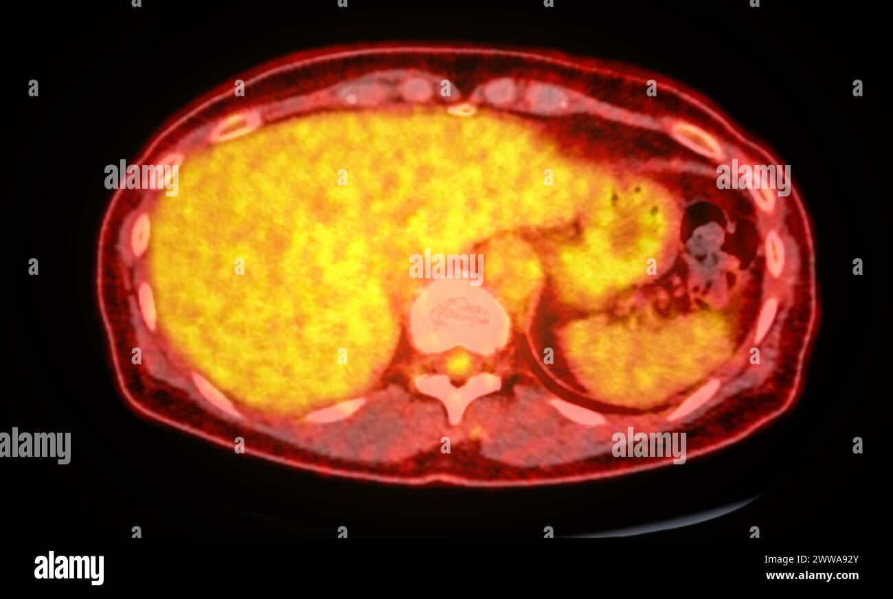 A PET-CT scan image is a diagnostic visualization combining Positron ...