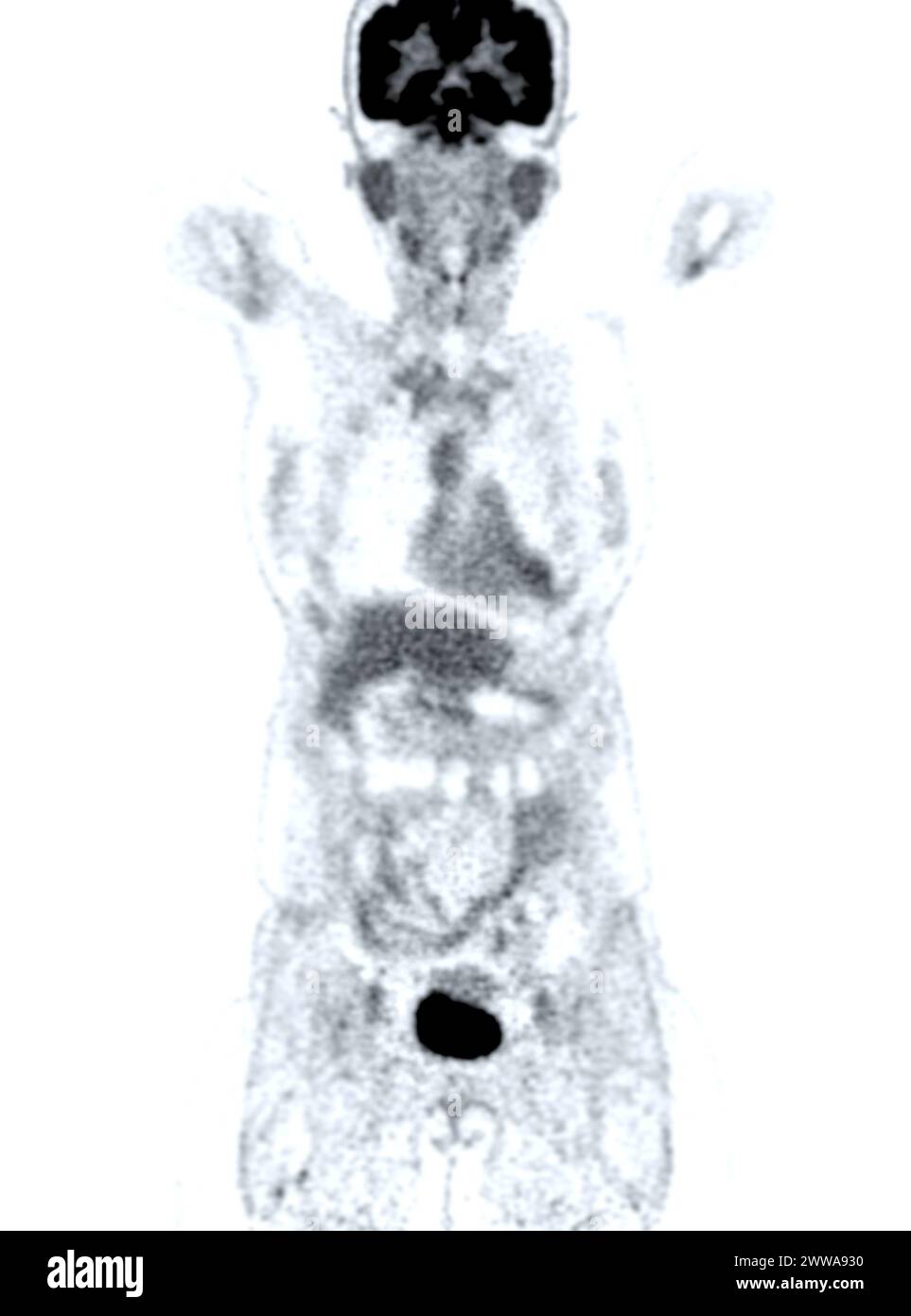 A PET-CT scan image is a diagnostic visualization combining Positron ...