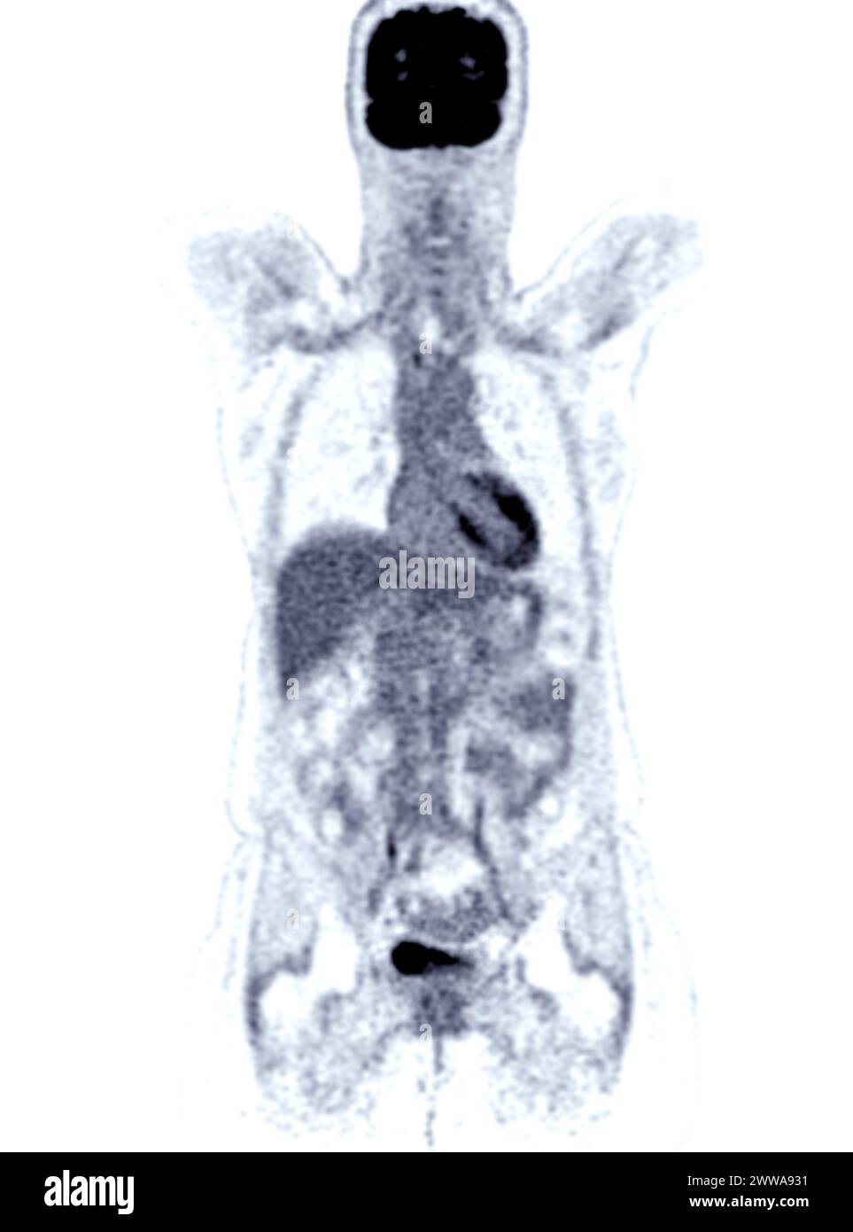 A PET-CT scan image is a diagnostic visualization combining Positron ...
