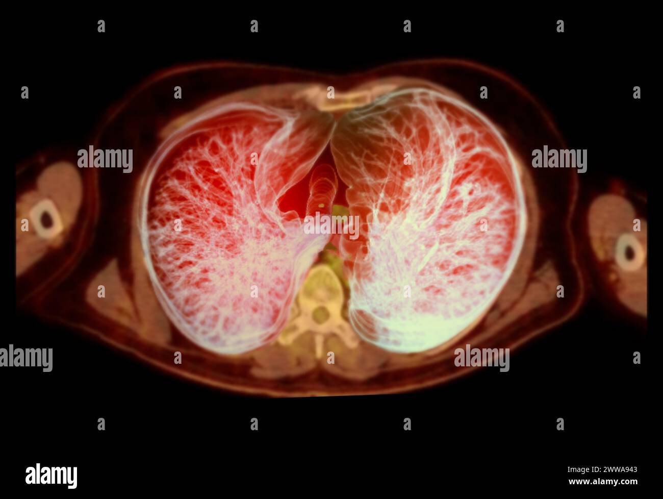 A PET-CT scan image is a diagnostic visualization combining Positron ...