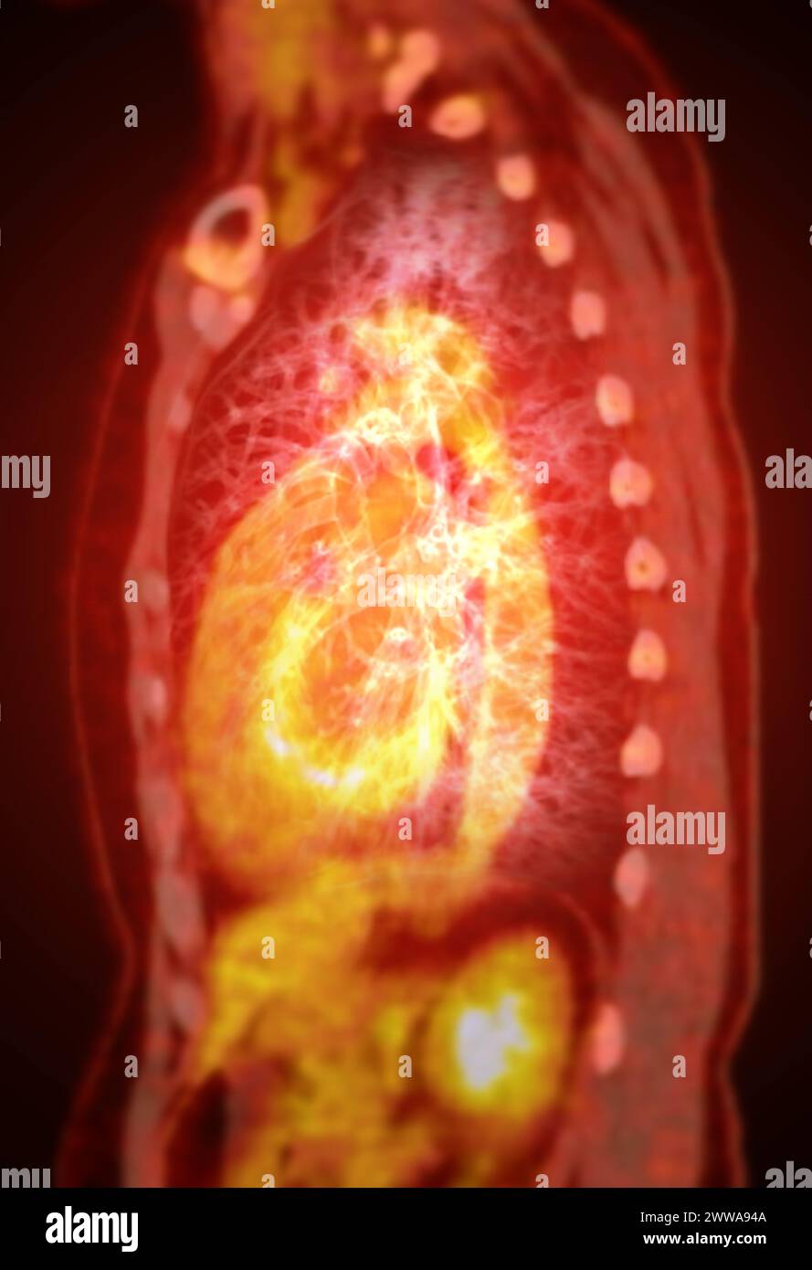 A PET-CT scan image is a diagnostic visualization combining Positron ...