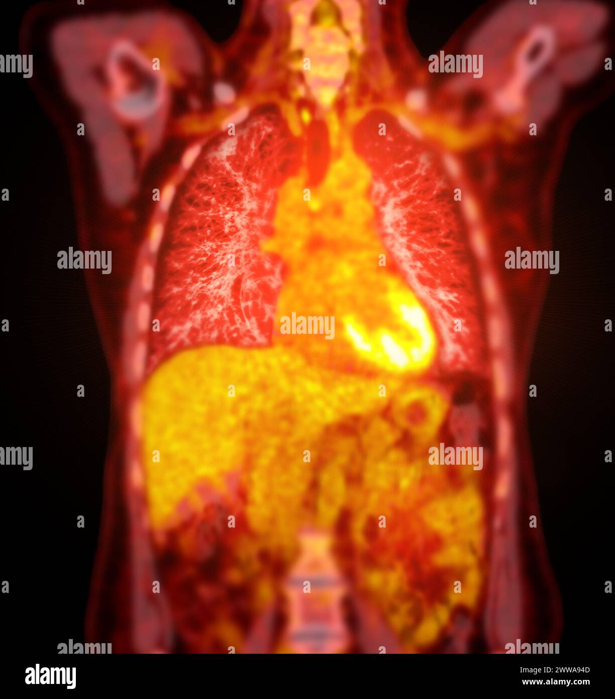 A PET-CT scan image is a diagnostic visualization combining Positron ...