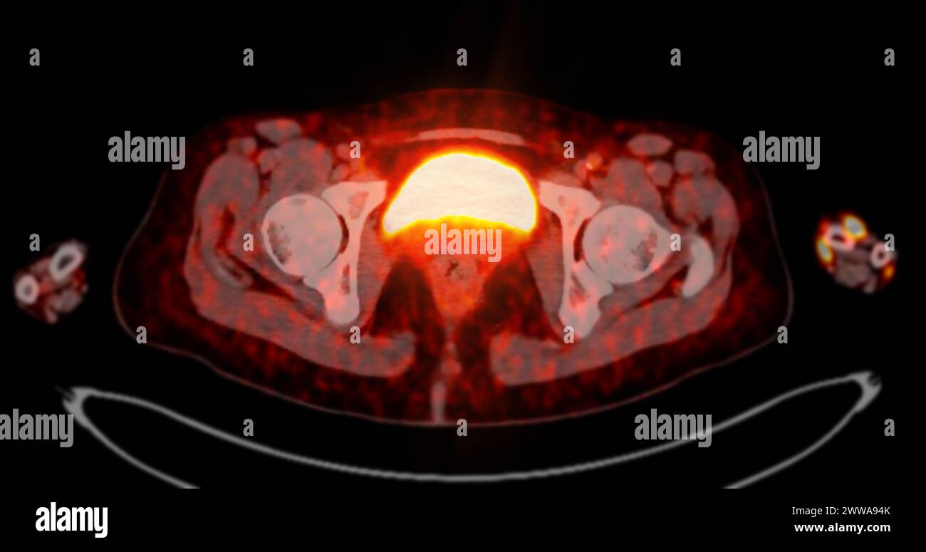 A PET-CT scan image is a diagnostic visualization combining Positron ...