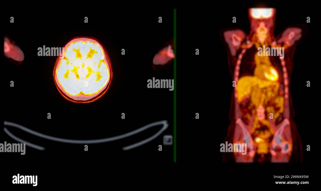 Brain pet scan screen hi-res stock photography and images - Alamy