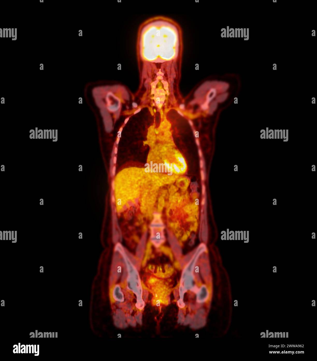 A PET-CT scan image is a diagnostic visualization combining Positron ...