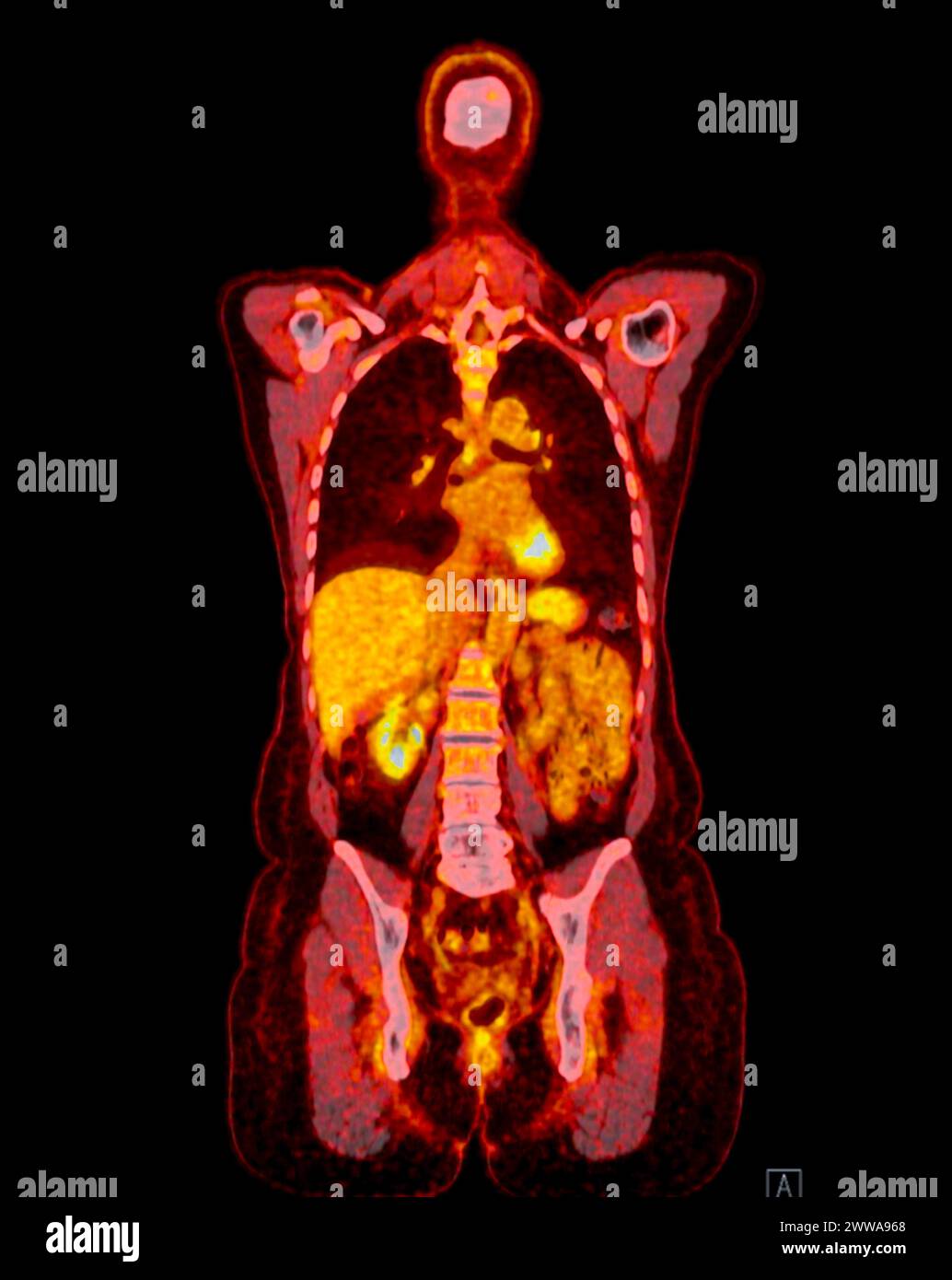 A PET-CT scan image is a diagnostic visualization combining Positron Emission Tomography (PET ...