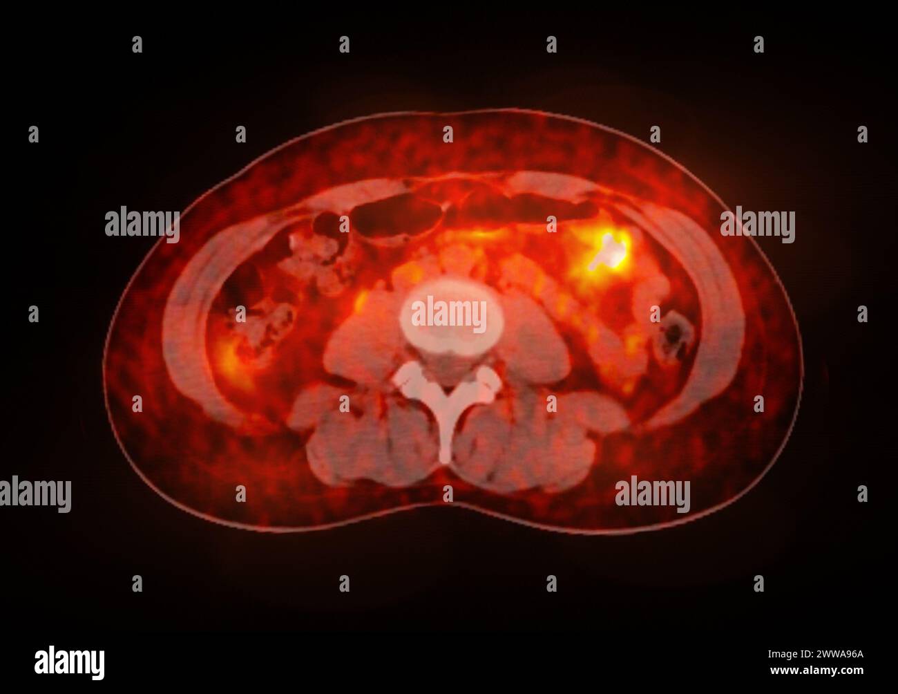 A PET-CT scan image is a diagnostic visualization combining Positron ...