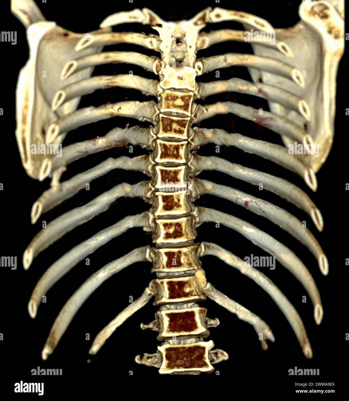 Rib fracture hi-res stock photography and images - Alamy