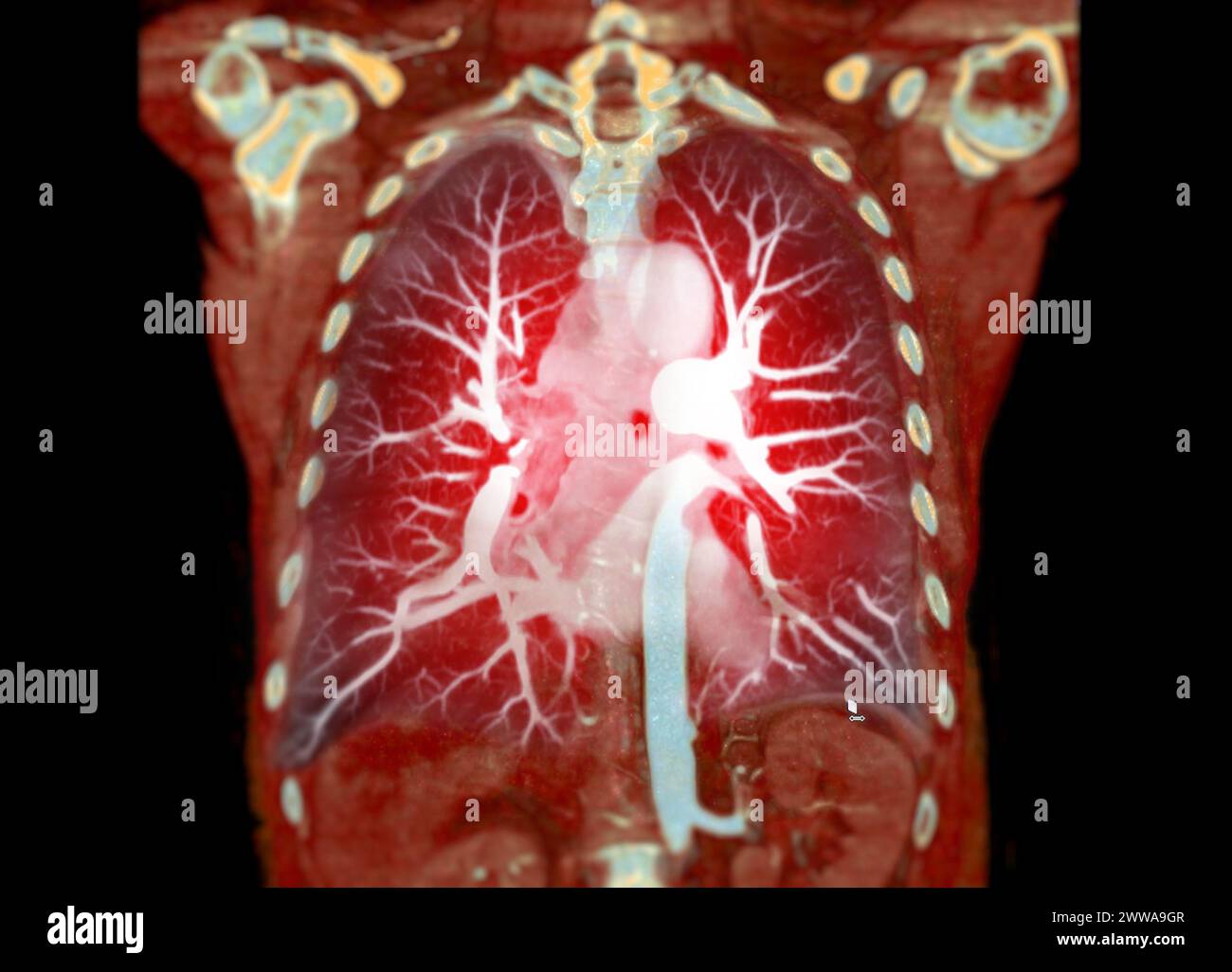 CTA thoracic aorta 3D rendering offers detailed visualization ...