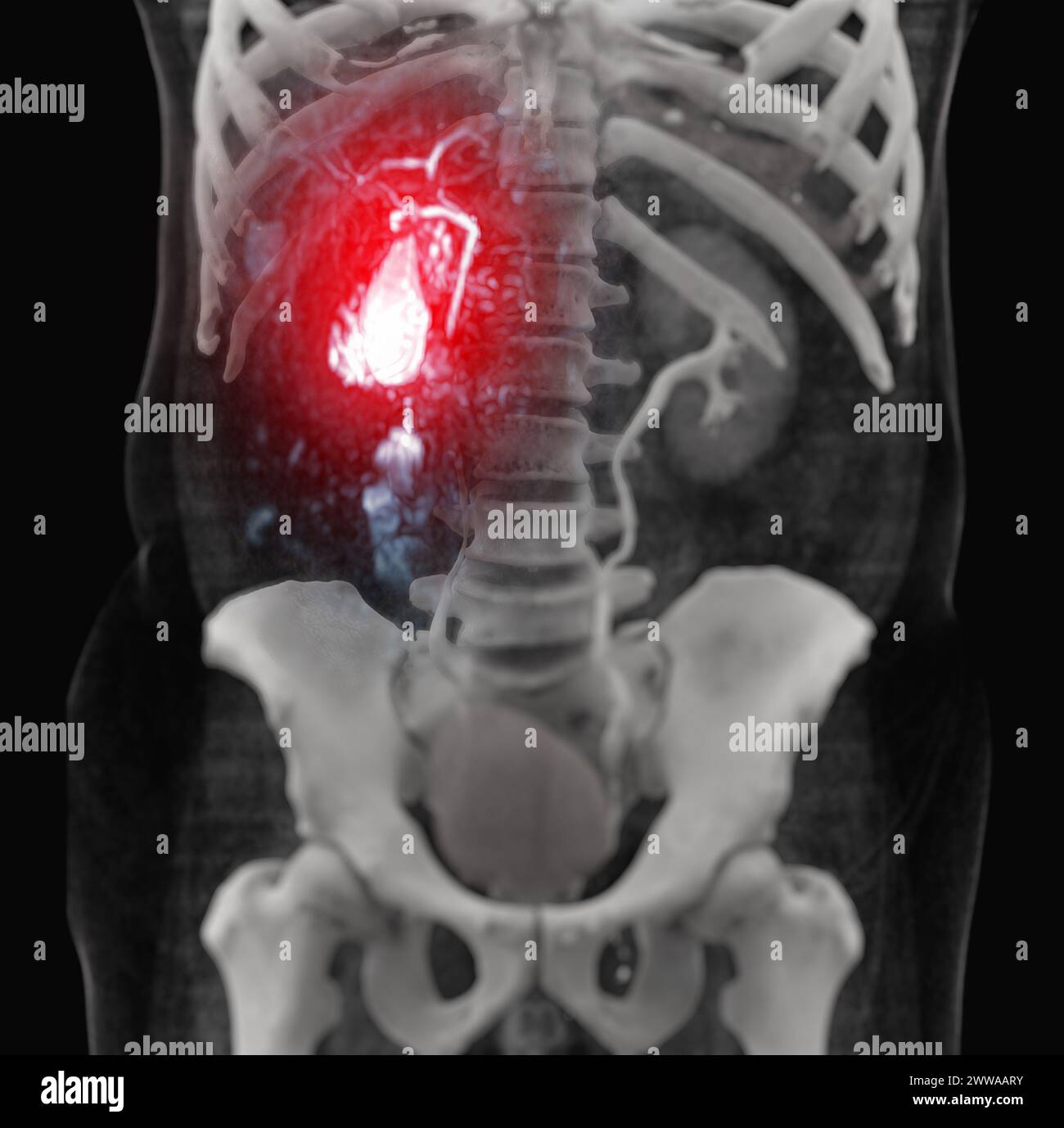 Magnetic resonance cholangiopancreatography or MRCP showing Gallbladder ...