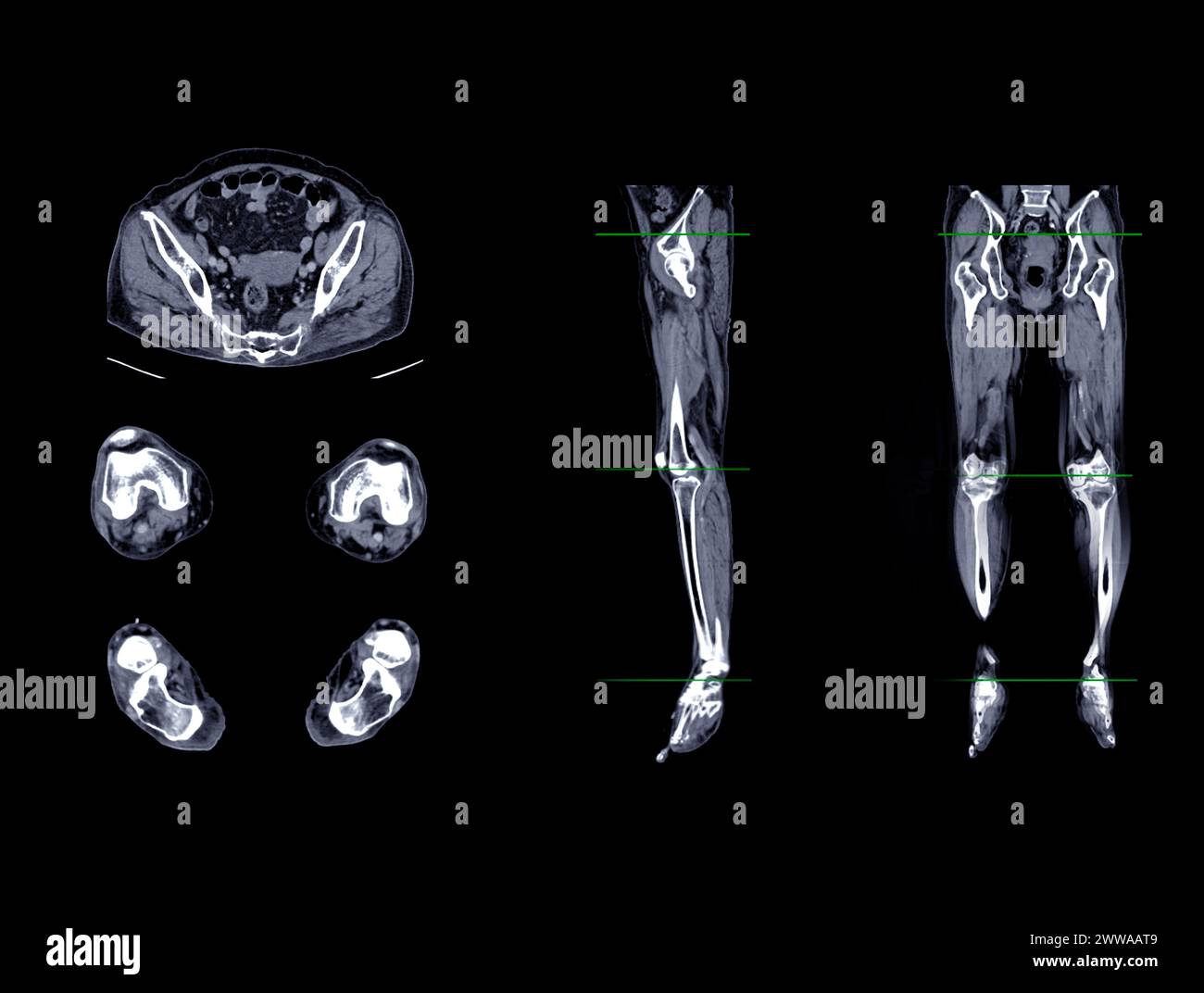A CT venogram of the leg is a non-invasive imaging procedure offering ...