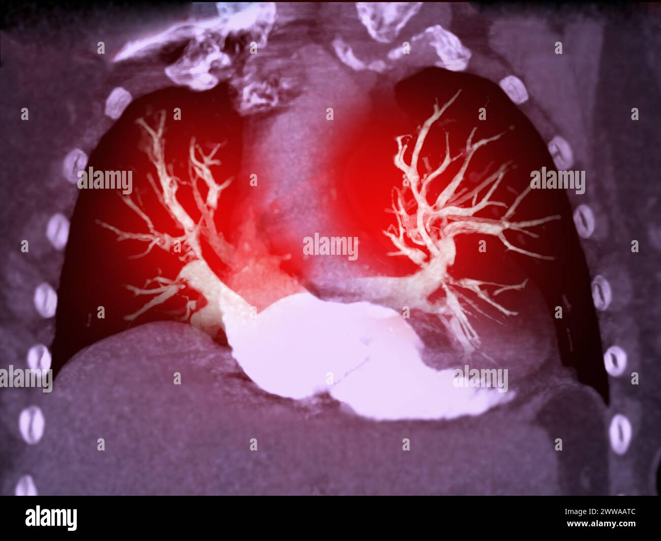 CTA Chest or CTPA with contrast media 3D rendering for diagnostic ...