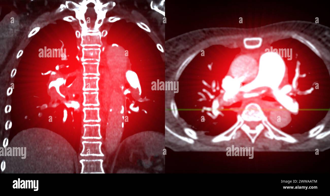 A CTA pulmonary artery reveals a detailed view of the lung blood ...