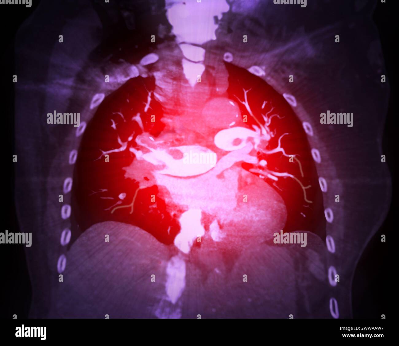 A CTA pulmonary artery reveals a detailed view of the lung blood ...