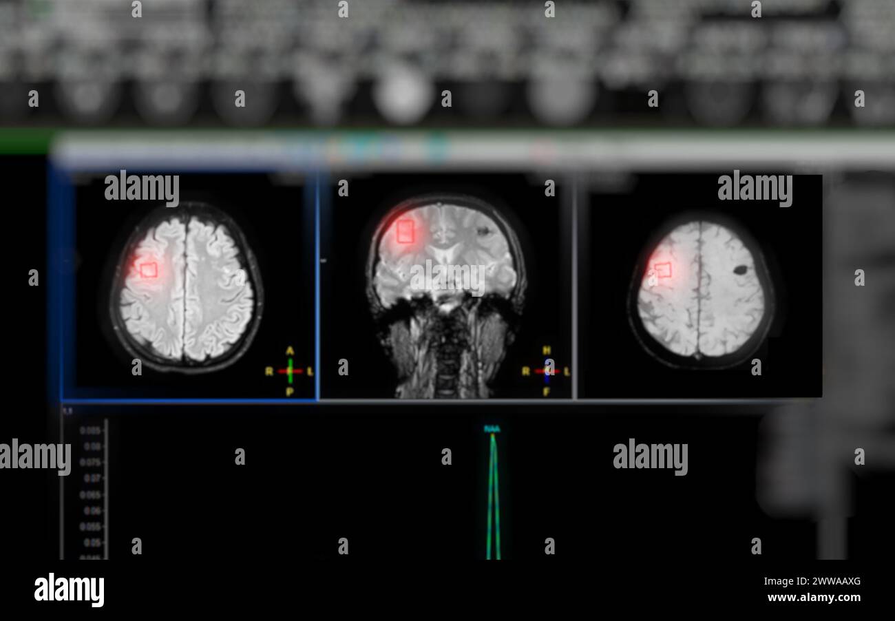 MR spectroscopy aids in stroke diseases, providing insightful chemical ...