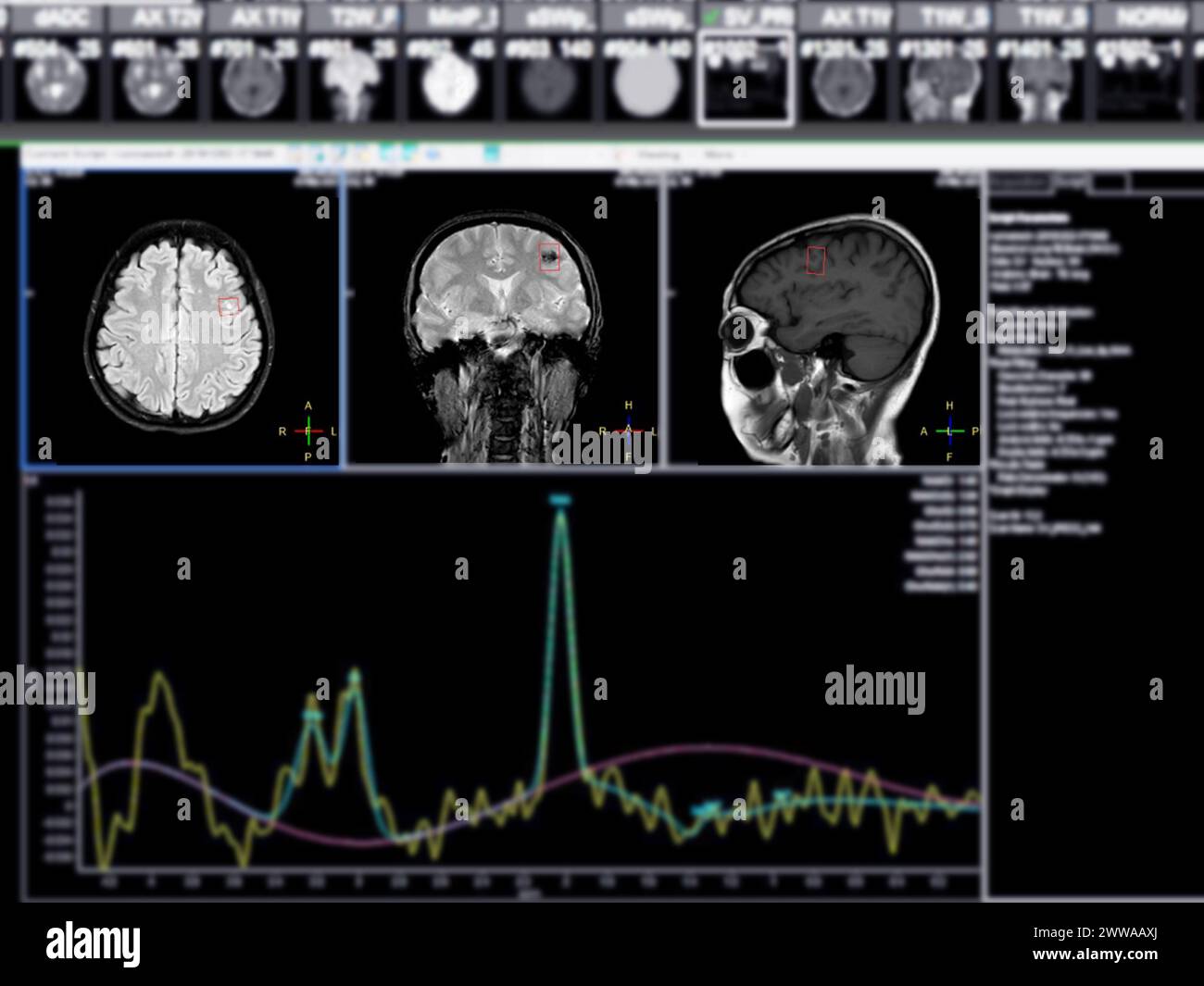 MR spectroscopy aids in stroke diseases, providing insightful chemical analysis to understand ...