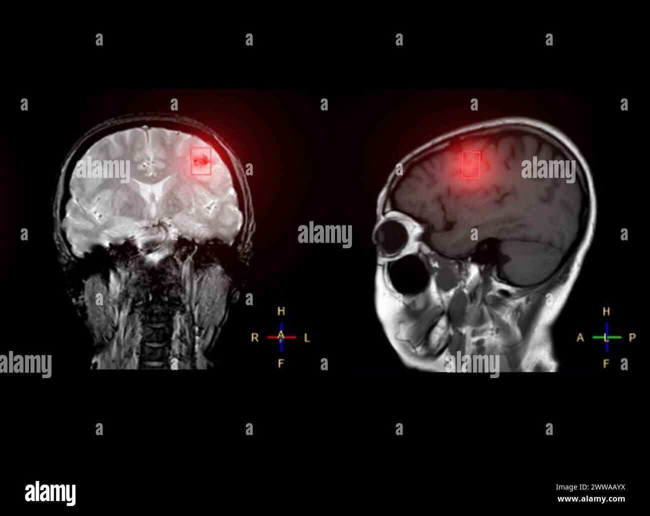 Mri brain spectroscopy hi-res stock photography and images - Alamy