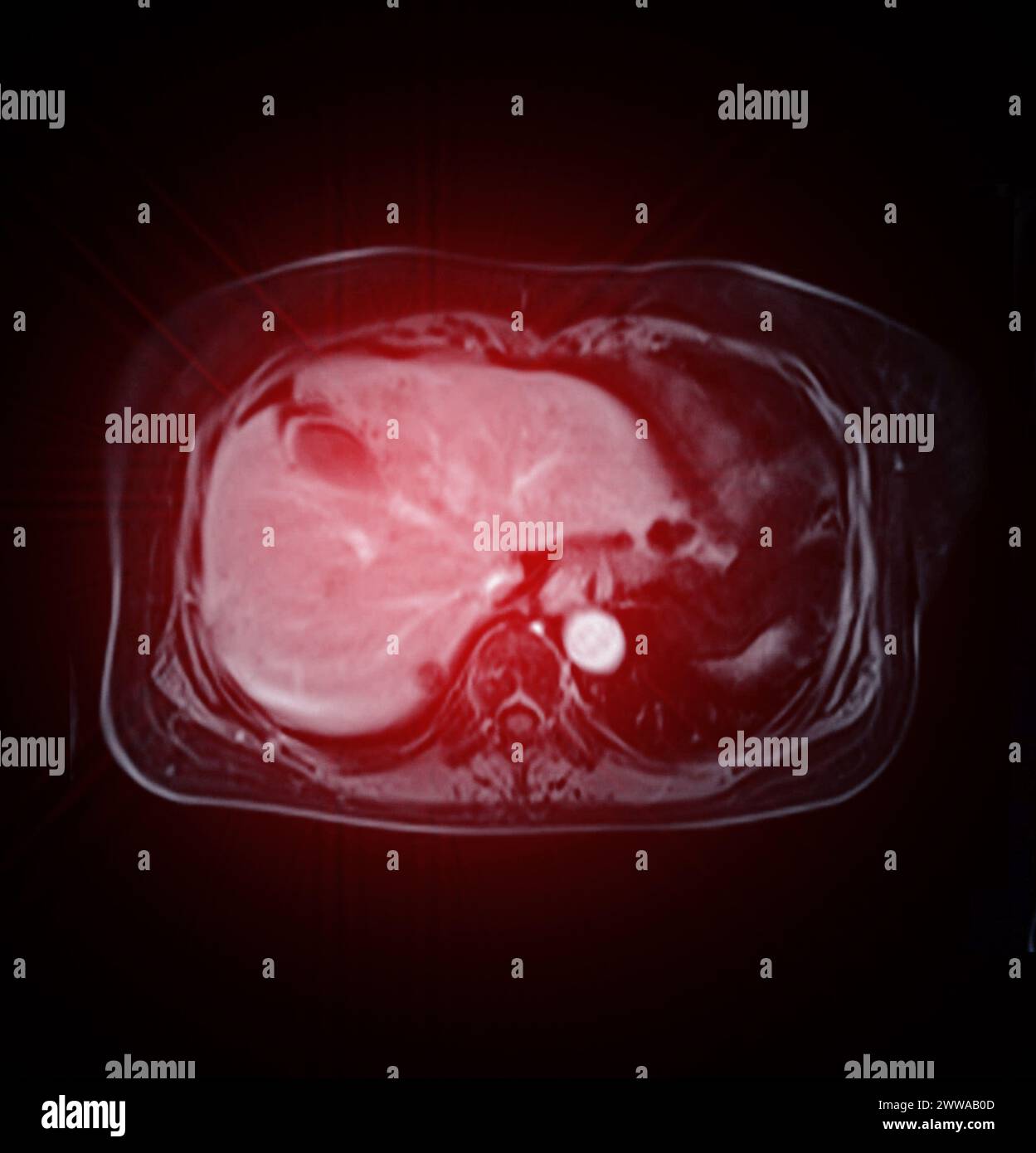 MRI of the upper abdomen coronal view is a non-invasive imaging ...