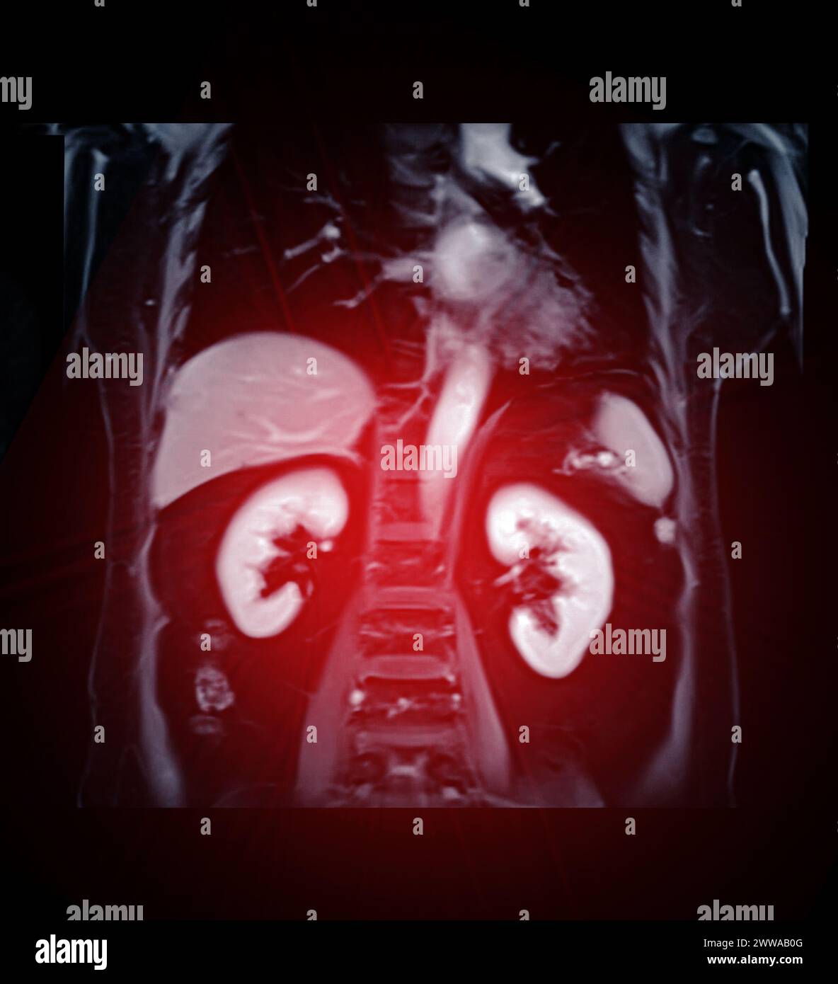 MRI of the upper abdomen coronal view is a non-invasive imaging ...