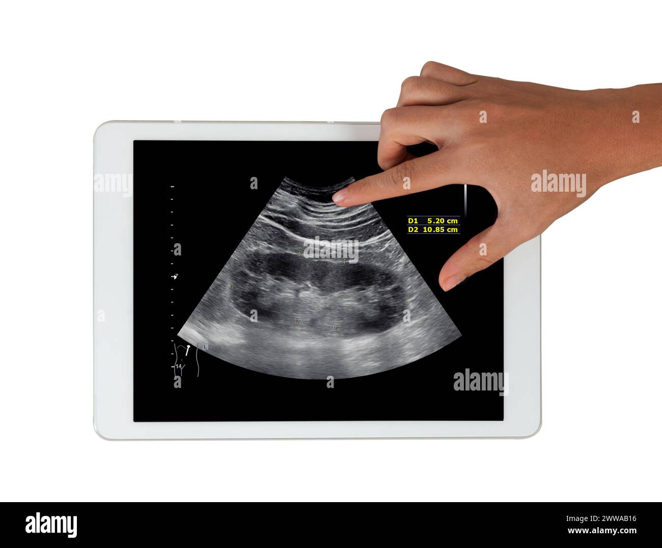 On a tablet against a white background, the ultrasound image of a ...