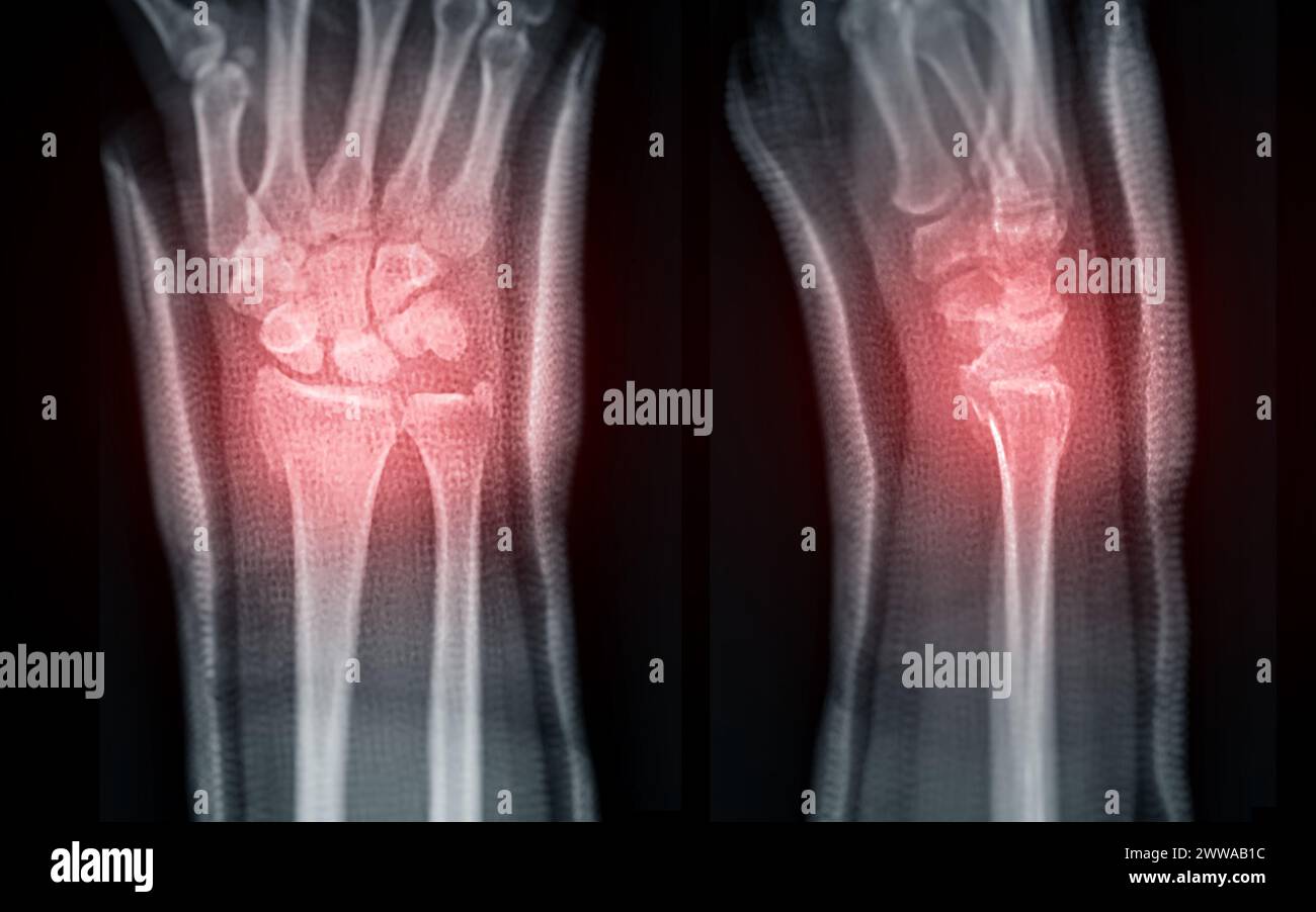The X-ray image vividly displays a wrist joint fracture, offering a ...
