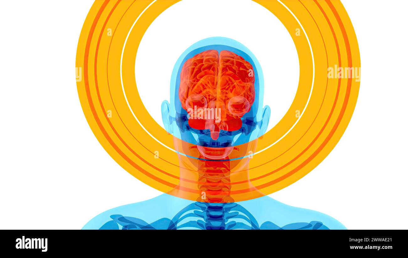 Headache, conceptual illustration Stock Photo - Alamy