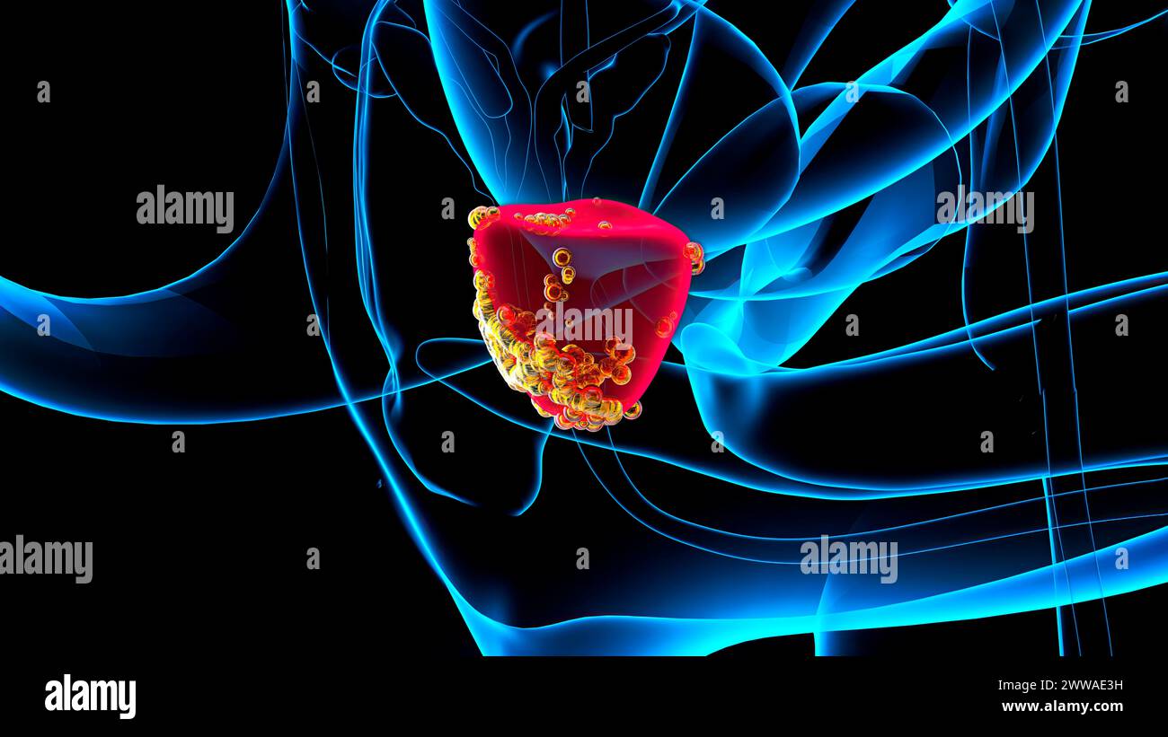 Prostate cancer, conceptual illustration Stock Photo - Alamy