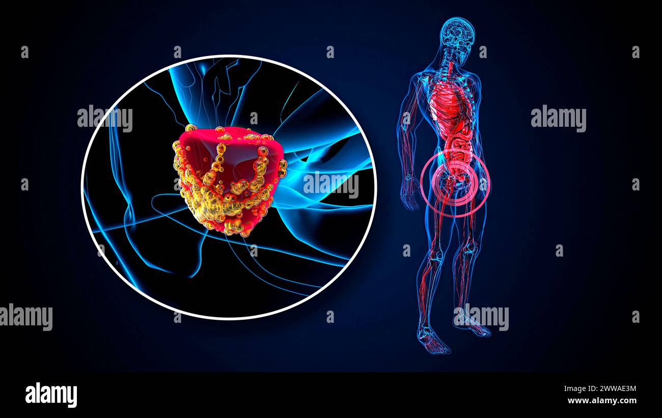 Prostate cancer, conceptual illustration Stock Photo - Alamy