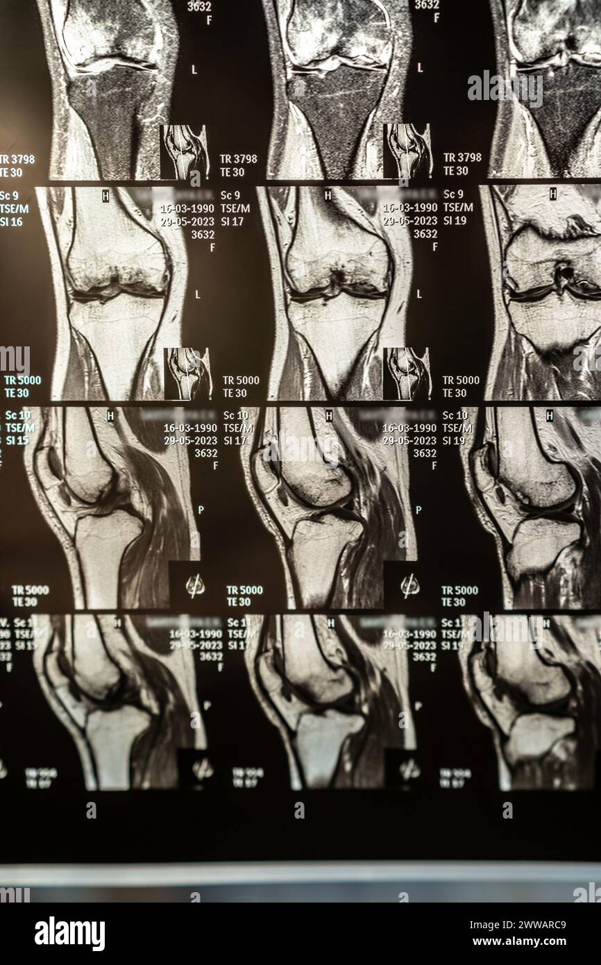 Magnetic resonance imaging of human knee joint for medical diagnosis ...
